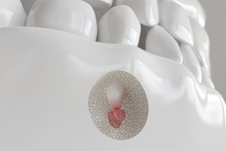 Apicoectomy | Root Canal | Williamsport, PA | Susquehanna OMFS